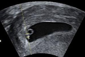 Was passiert in der 6. SSW? - urbia.de